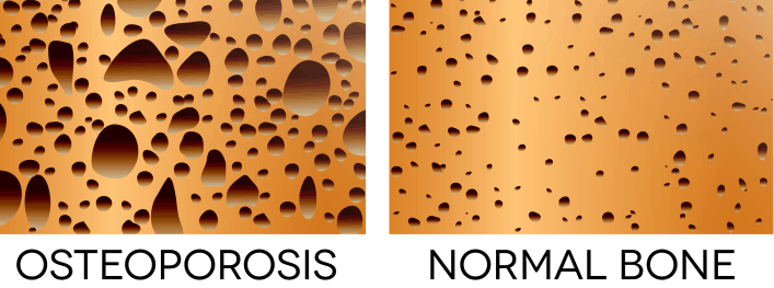 Feminorm Osteo - уникална комбинация за здрави кости и менопауза | GPNews